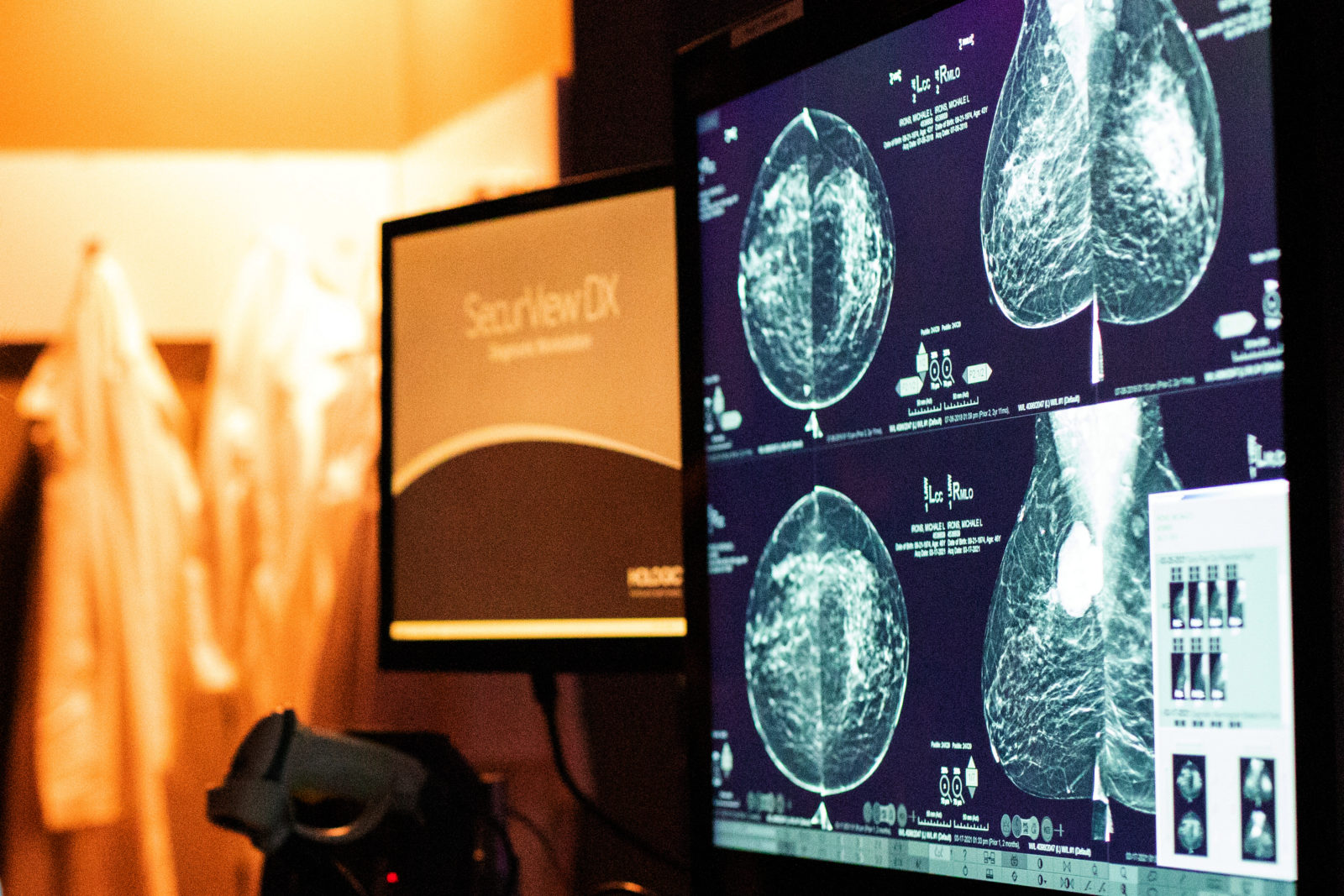 3D Screening Mammography - Mallinckrodt Institute of Radiology ...